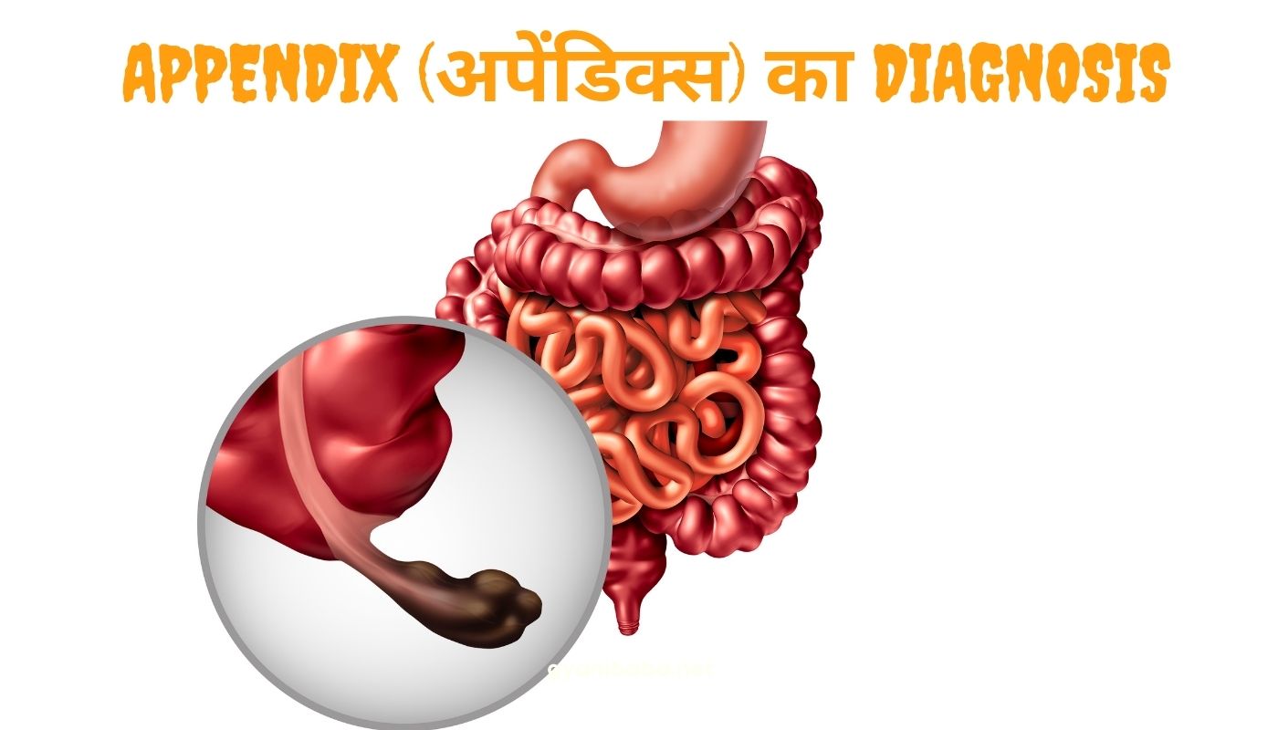 Appendix Kya Hota Hai, जानिये Kyun Hota Hai | Kaise Hota Hai